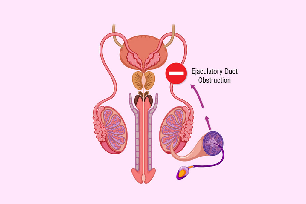 Ejaculatory Duct Obstruction: Causes, Symptoms and Treatment