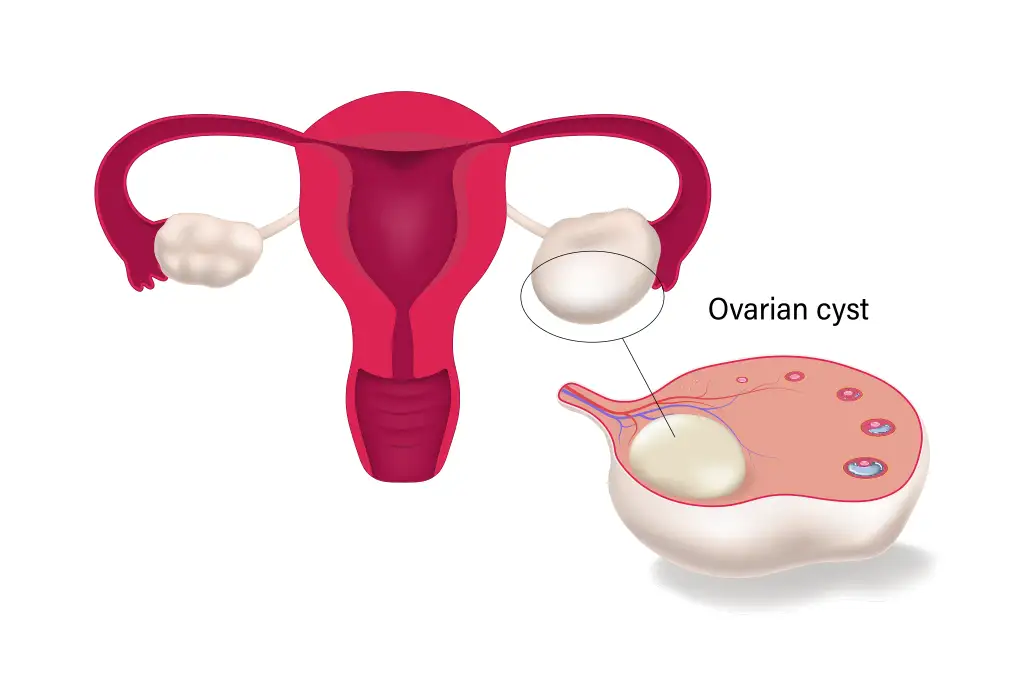 Pregnant With Ovarian Cyst , Ultimate Guide to Ovarian Cysts and ...